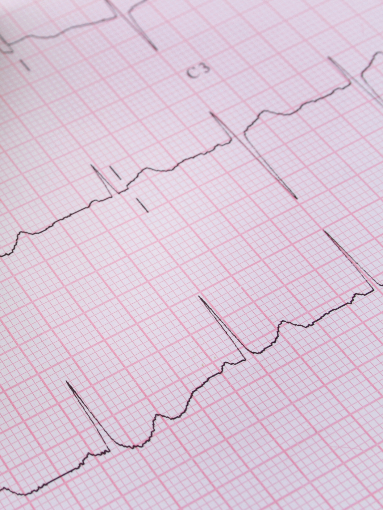 Artimie cardiaca: Simptome si Optiuni de Tratament | MONZA ARES